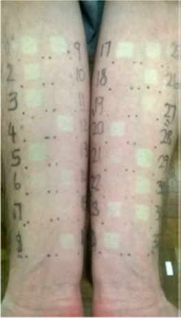 Bioequivalence Vasoconstriction Assay Studies for Topical ...